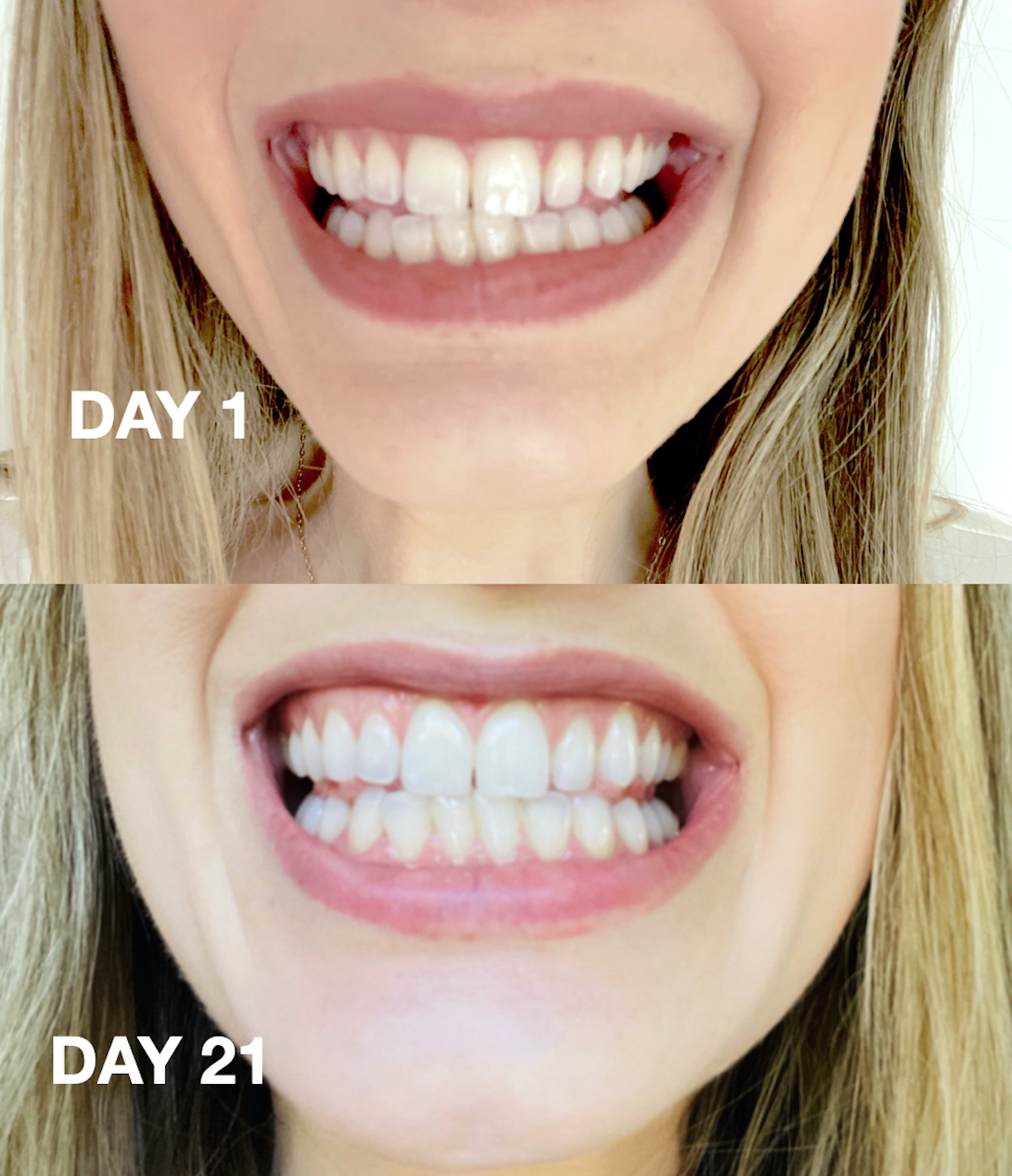 Snow Teeth Whitening is the New & Better Way to Whiten Teeth!